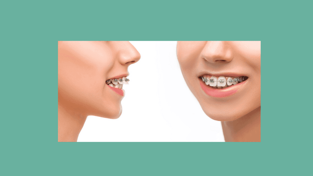 What Is an Overbite and How Can It Be Fixed?