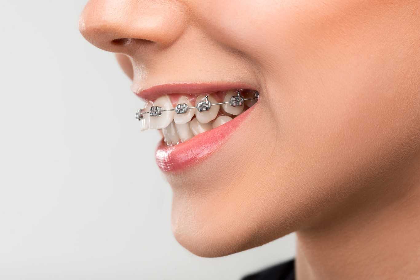 What Is an Overbite and How Can It Be Fixed?
