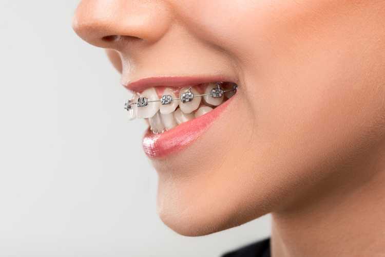 What Is an Overbite and How Can It Be Fixed?